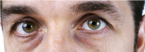 Cernes noirs : causes, solutions et soins efficaces pour les peaux ...